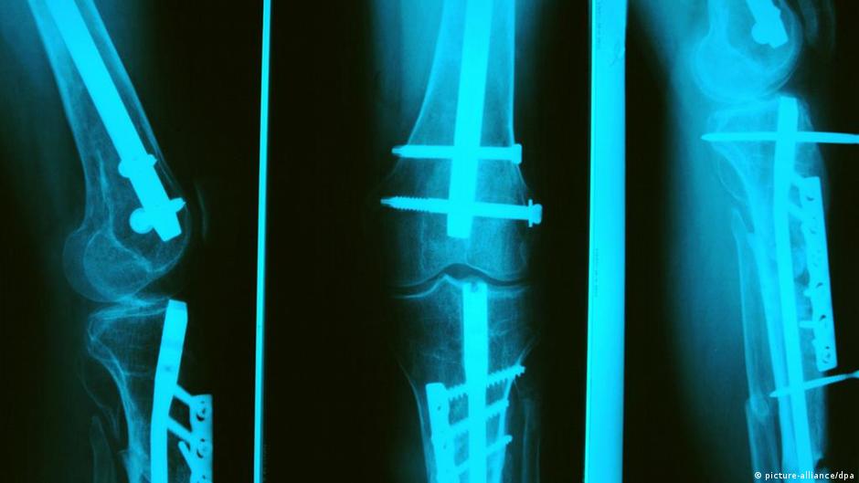 Repair set for bone fractures – DW – 03/17/2023