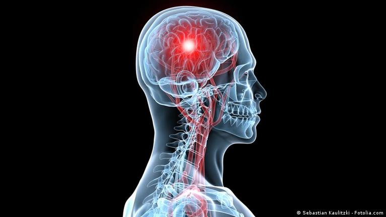 Cuando golpea la apoplejía – DW – 27/10/2017