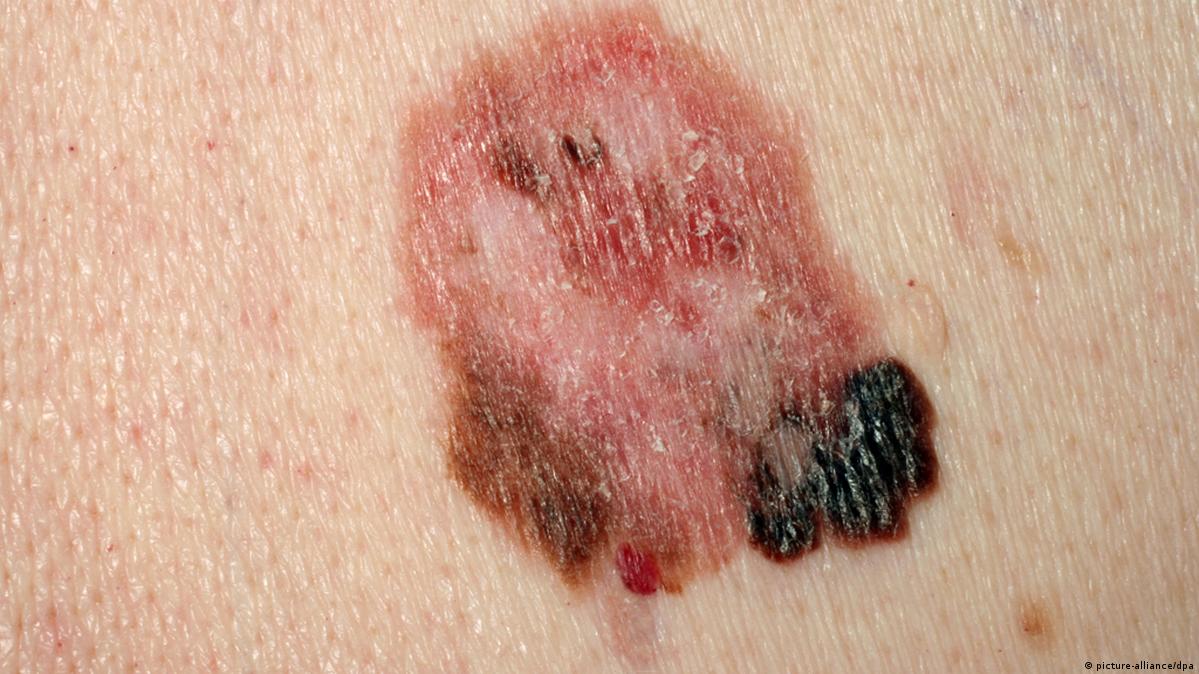 Kanker Kulit : Mekanisme Sel Menjadi Ganas – DW – 30.01.2013