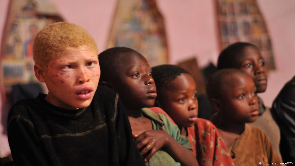 Albinos stand up for their rights – DW – 10/19/2013