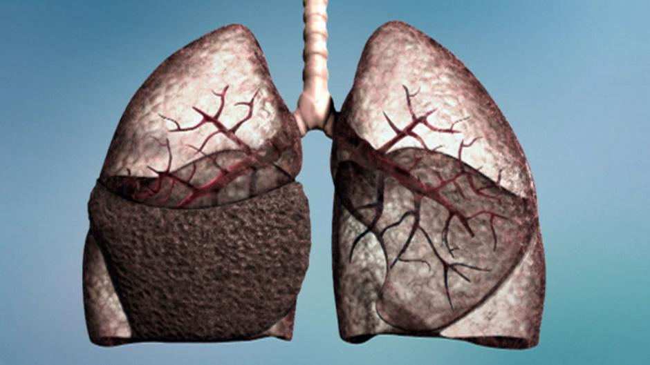 La tos como síntoma – DW – 14/02/2013