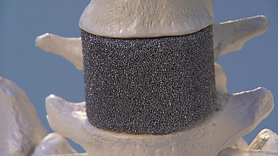 Metal Foam - a material for new bones – DW – 02/28/2013
