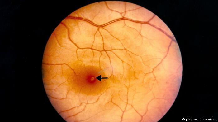 Seeing the eye as a window to disease elsewhere | Science | In-depth ...