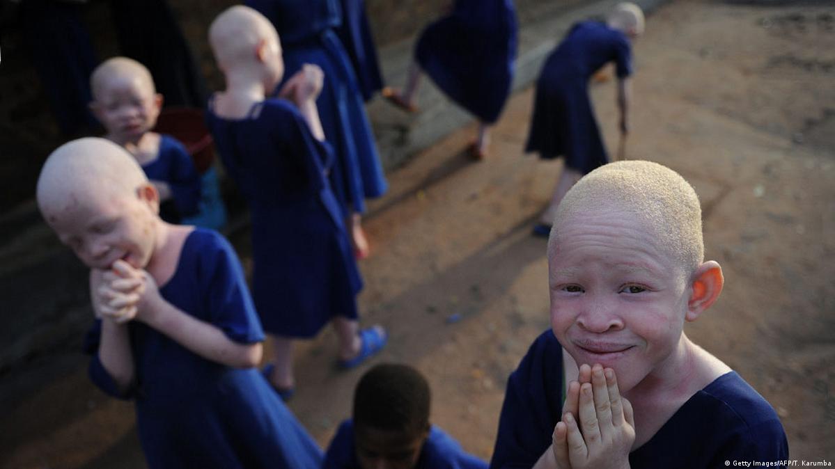 Albinos en Tanzania: amenazados y deportados