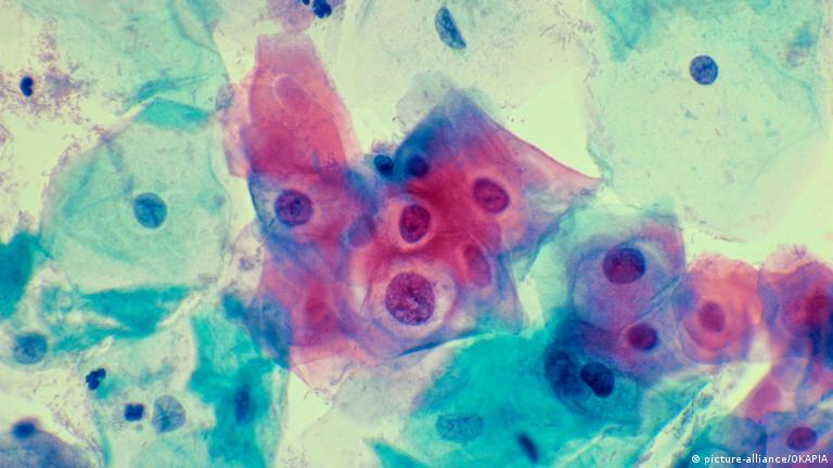 Pap ASCUS là gì - Tìm hiểu và Giải pháp hiệu quả nhất