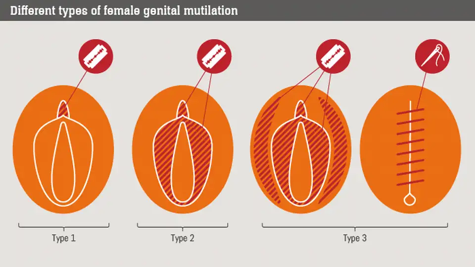 Infibulation In Men Attitudes Towards Comparison Of Male And Female
