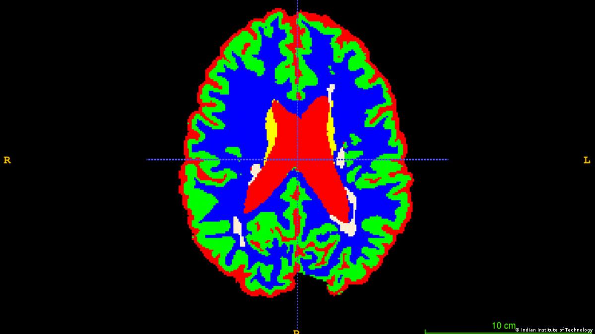 An algorithm against multiple sclerosis – DW – 09/04/2015