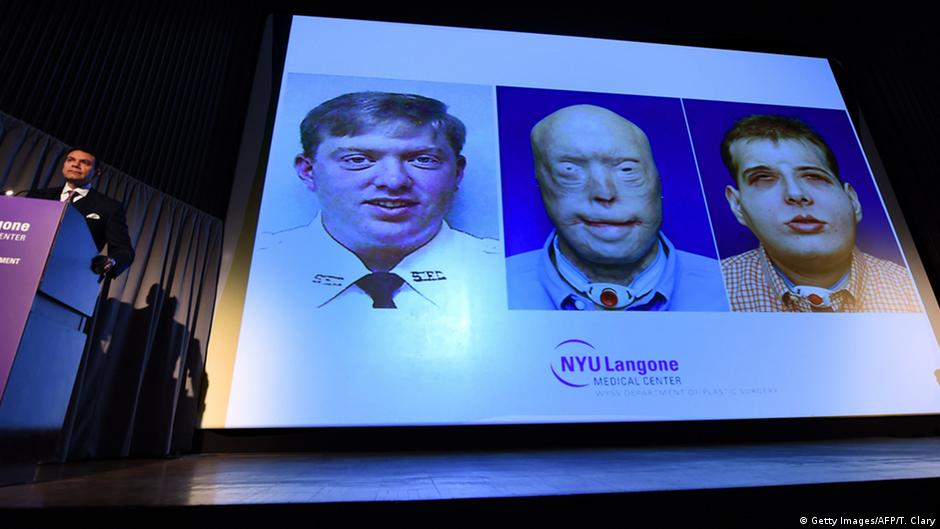 World-first face transplant – DW – 11/17/2015