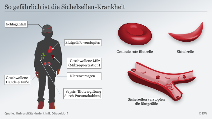 Zehn Fragen und Antworten zur Sichelzellen-Krankheit | Wissen & Umwelt ...