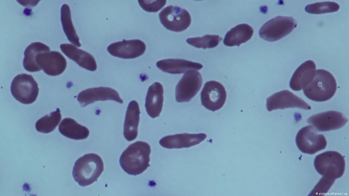 Was ist die Sichelzellen-Krankheit? – DW – 14.12.2015
