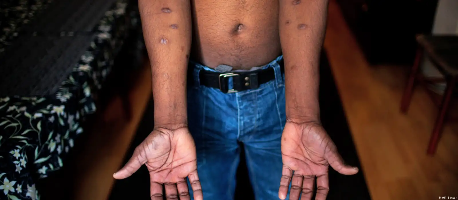 Cigarette Burn Torture