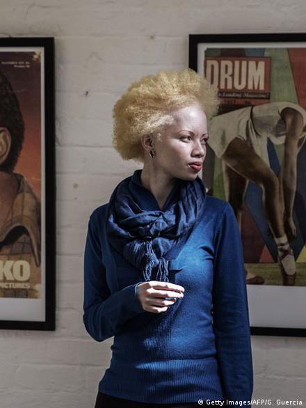 Albino Afro Americano