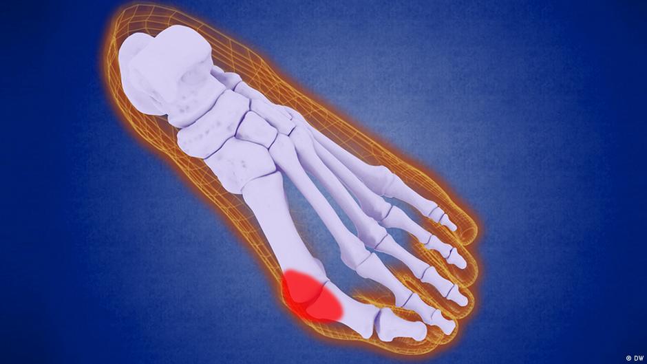 Bio-absorbable screws to fight hallux valgus