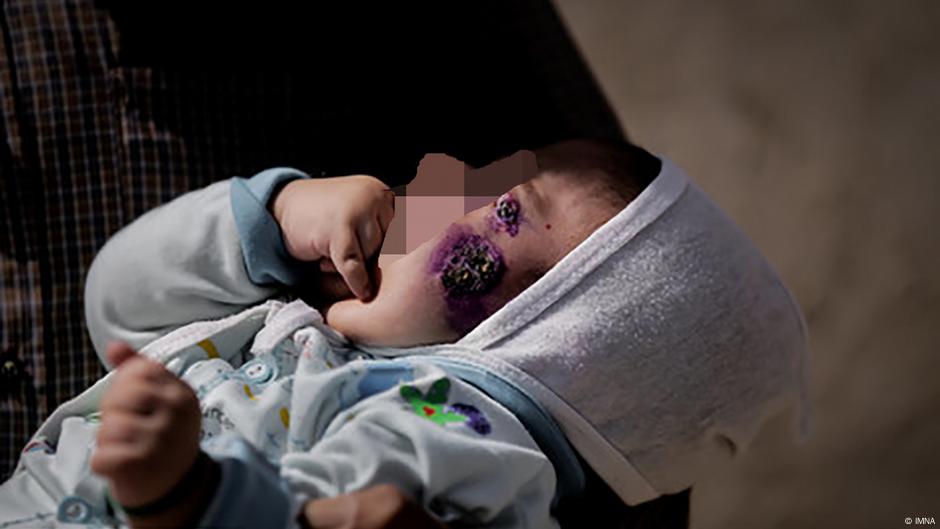 زنگ خطر سالک در ایران؛ ۳۸ مورد ابتلا در ورامین Dw ۱۴۰۰۱۰۲۲