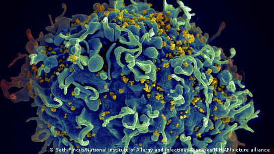 Pasien Ketiga HIV Berhasil Sembuh Berkat Terapi Sel Punca – DW – 16.02.2022