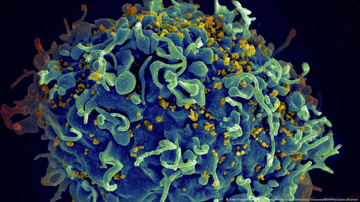 Varian Baru HIV yang “Sangat Ganas” Ditemukan di Belanda – DW – 04.02.2022