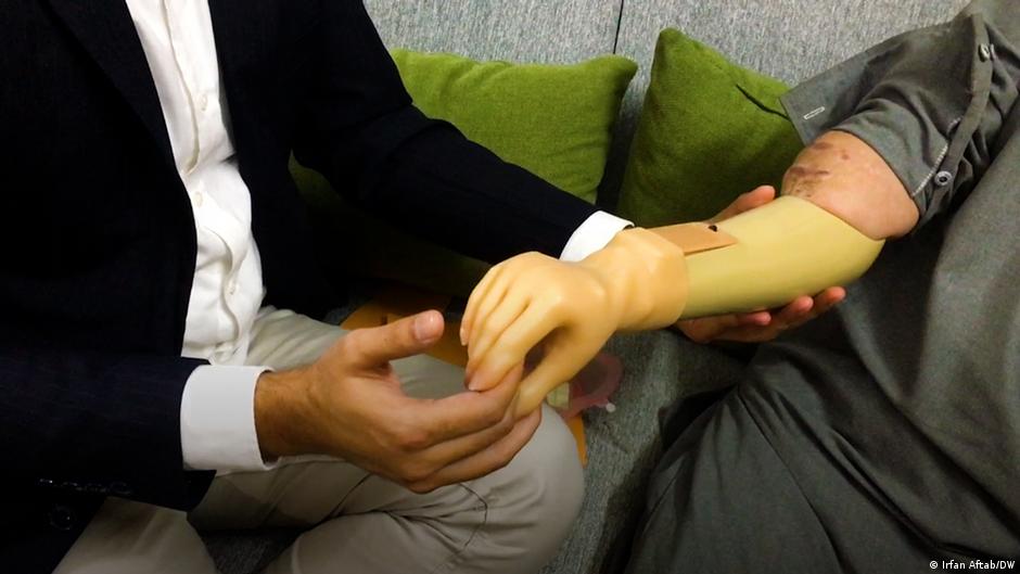 Prosthetic arm startup offers ray of hope to amputees – DW – 02/04/2022