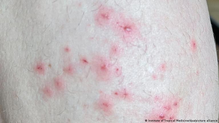 Monkeypox: Stigma undermines response, WHO says