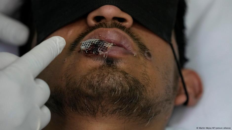 Who Warns Mpox Could Spread Around The World Again Dw 12202023