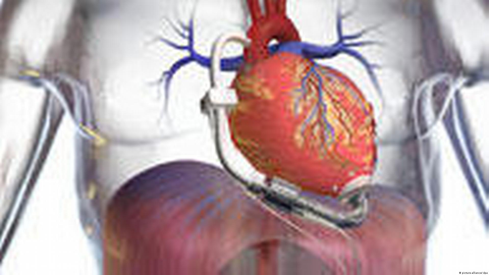 Eurodinámica: viviendo con un corazón artificial