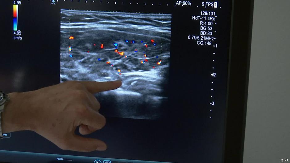 Qué es la tiroiditis de Hashimoto – DW – 02/03/2023