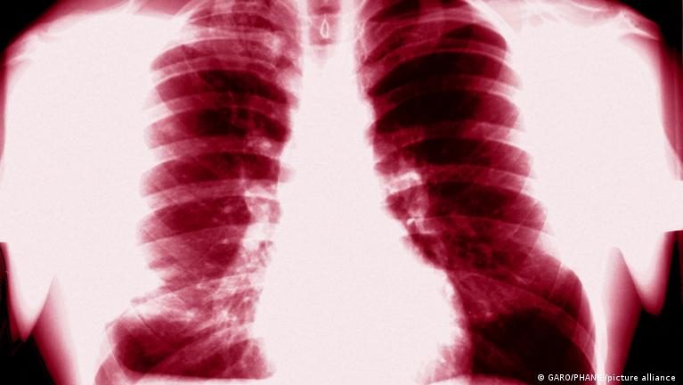 Major tuberculosis outbreak in Kansas city area, US