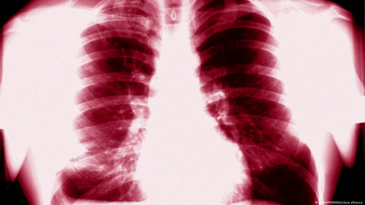 Major tuberculosis outbreak in Kansas city area, US