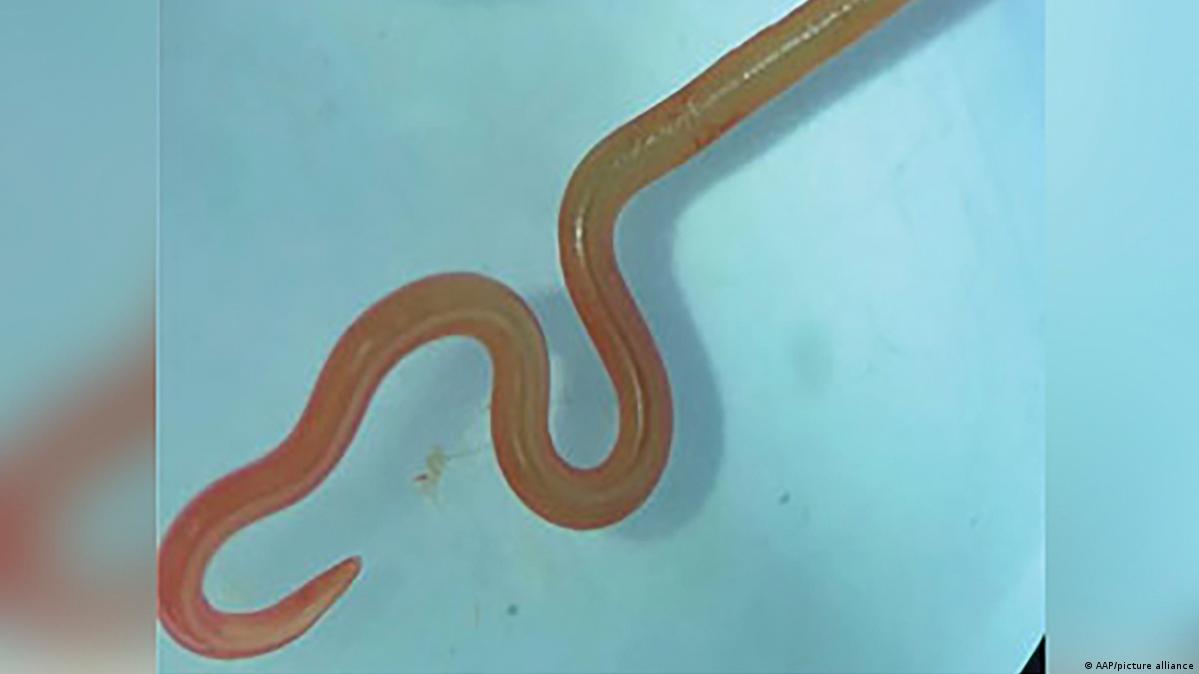 Lebender Wurm aus Gehirn einer Australierin entfernt – DW – 29.08.2023