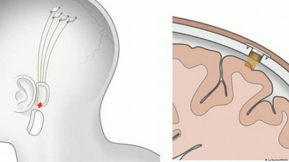 Neuralink probará chip cerebral para mover brazos robóticos – DW – 26 ...