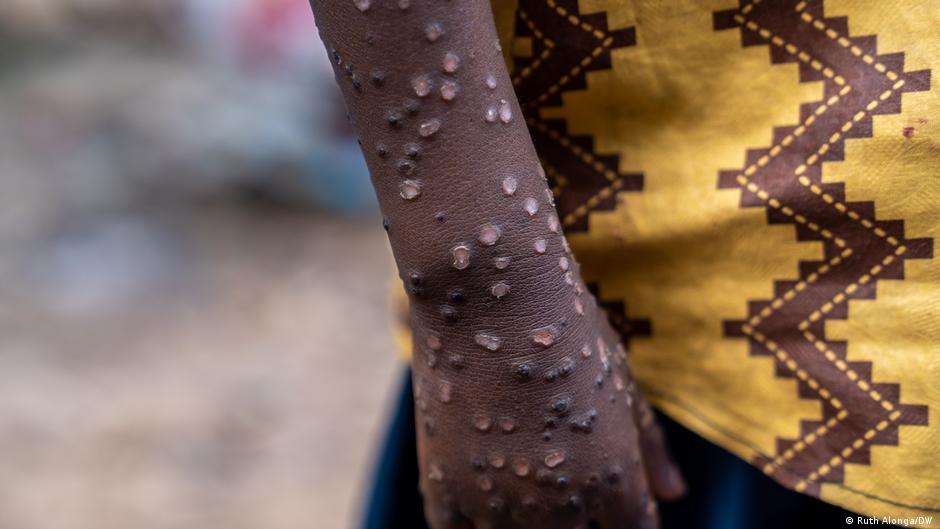 Wasiwasi juu ya ongezeko la wagonjwa wa mpox barani Afrika – DW – 28.08 ...
