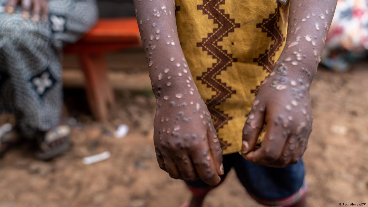 Congo’s refugee camps face severe mpox outbreak – DW – 08/26/2024