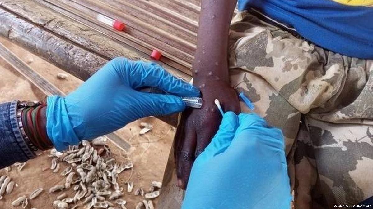 Mpox on the rise in Africa: Are there enough vaccines?