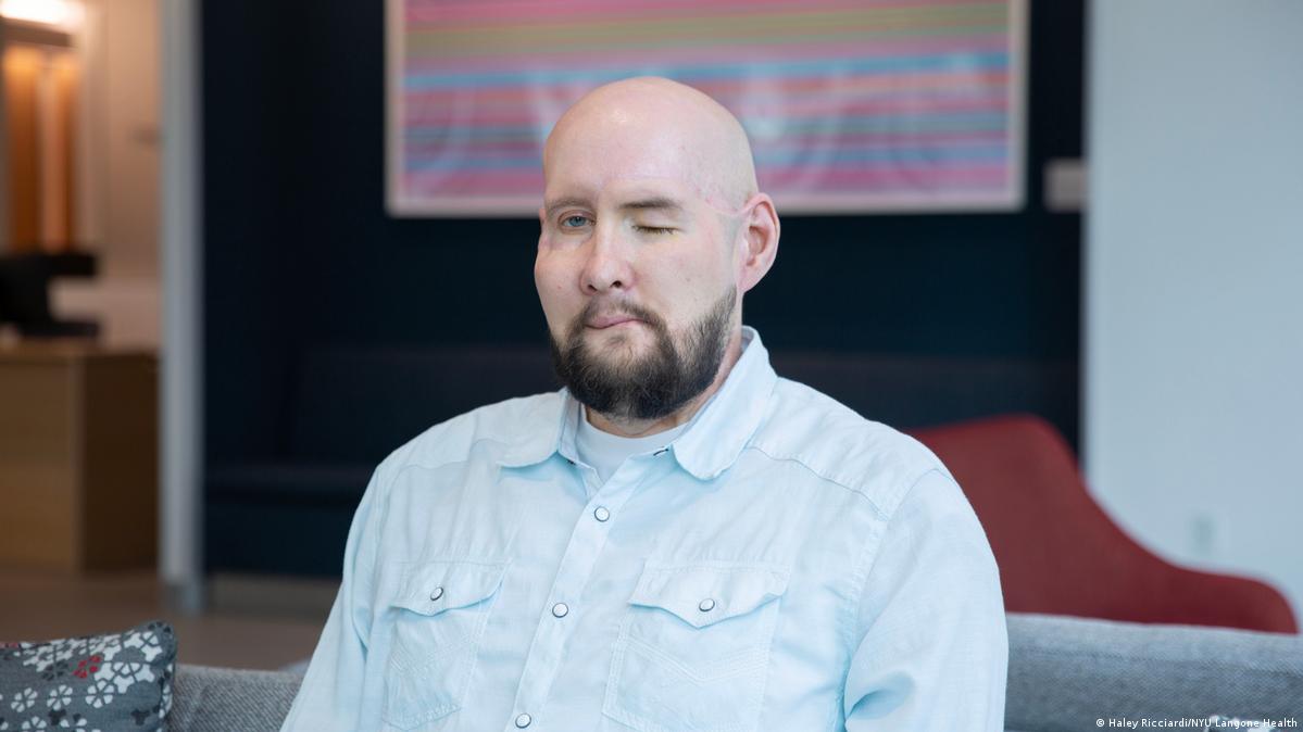 World-first face, eye transplant a 'cautious' success story – DW – 09 ...