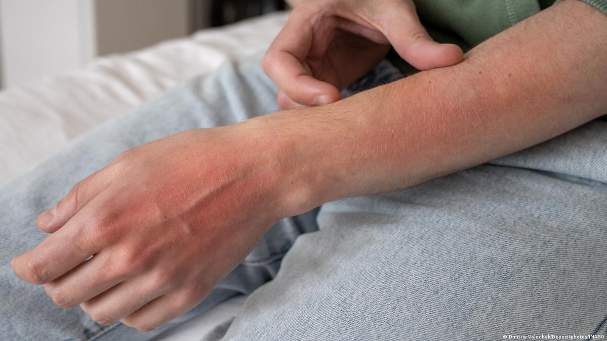 ¿Es malo rascarse? La ciencia tiene una respuesta inesperada – DW – 31 ...