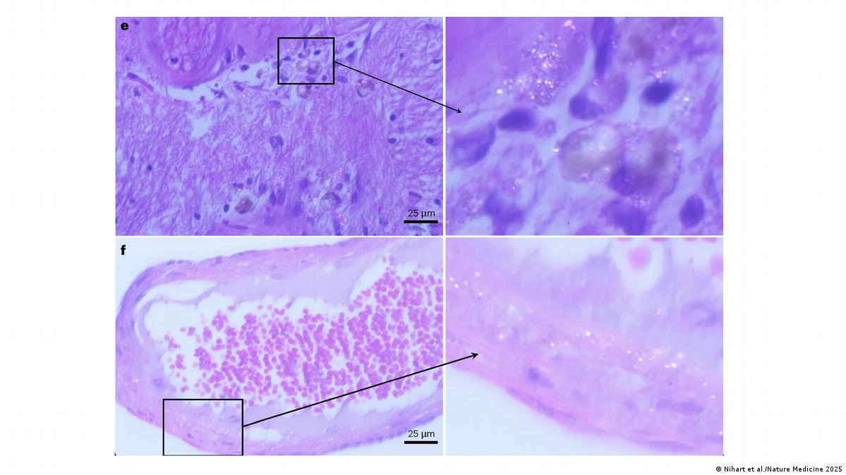 Study finds microplastics in US brains: Are they dangerous? – DW – 02 ...