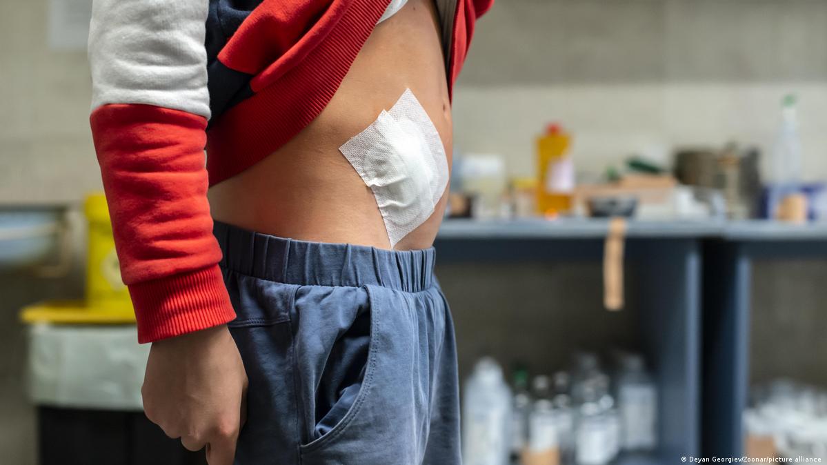 Appendix cancer rises in young people — but why? – DW – 06/17/2025