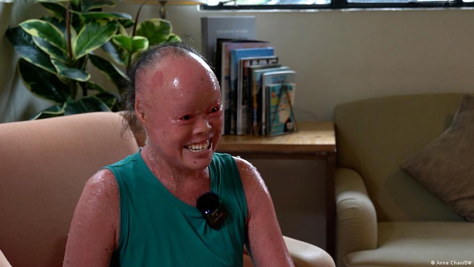 Mui Thomas: 'How my rare skin condition motivates me' – DW – 09/11/2025