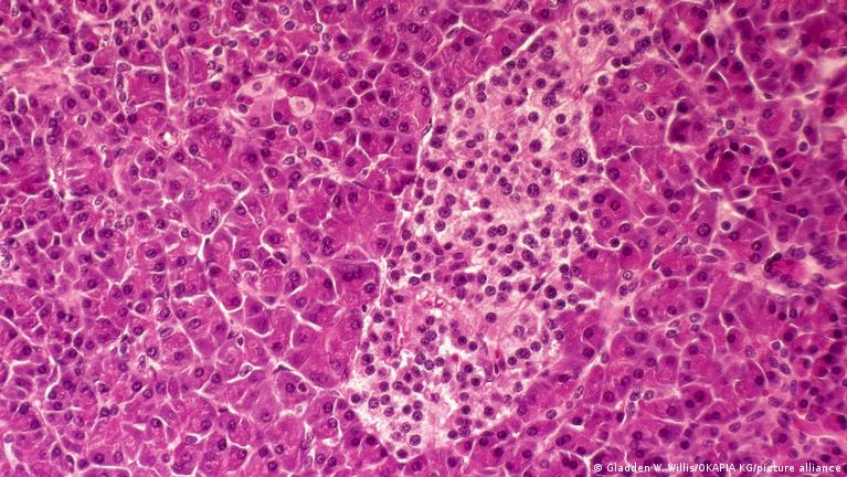 Pancreatic cancer: New drug extends lives but isn't a cure
